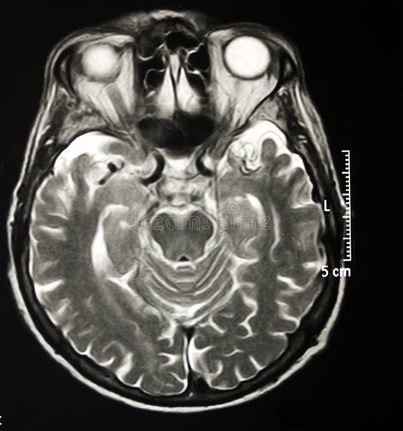 MRI of the Brain, Brain Tumor - MR Stock Photo - Image of tumor ...