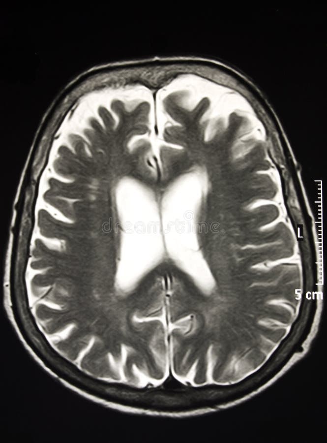 MRI scan image of brain stock photo. Image of diagnosis - 34023806