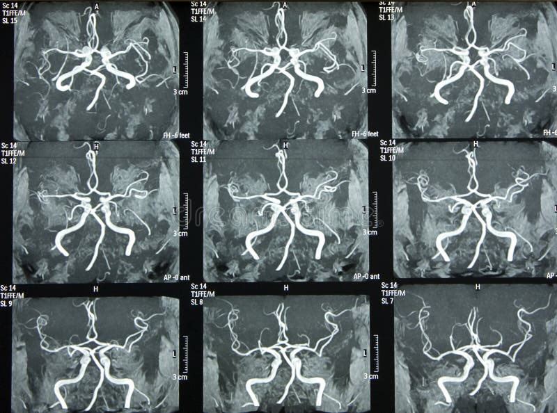 Magnetic Resonance of Brain, MR Stock Image - Image of skull, headache ...