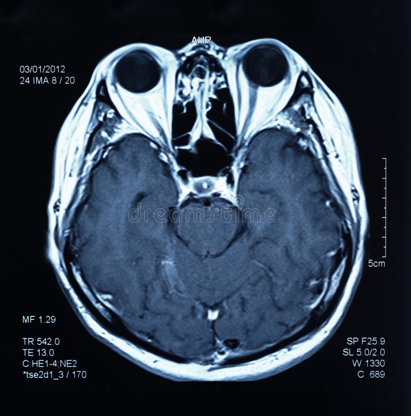 Mri scan brain stock image. Image of resonance, doctor - 209248675