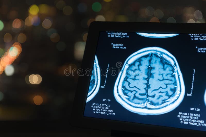 Brain scan images stock photo. Image of cancer, radiology - 190923130