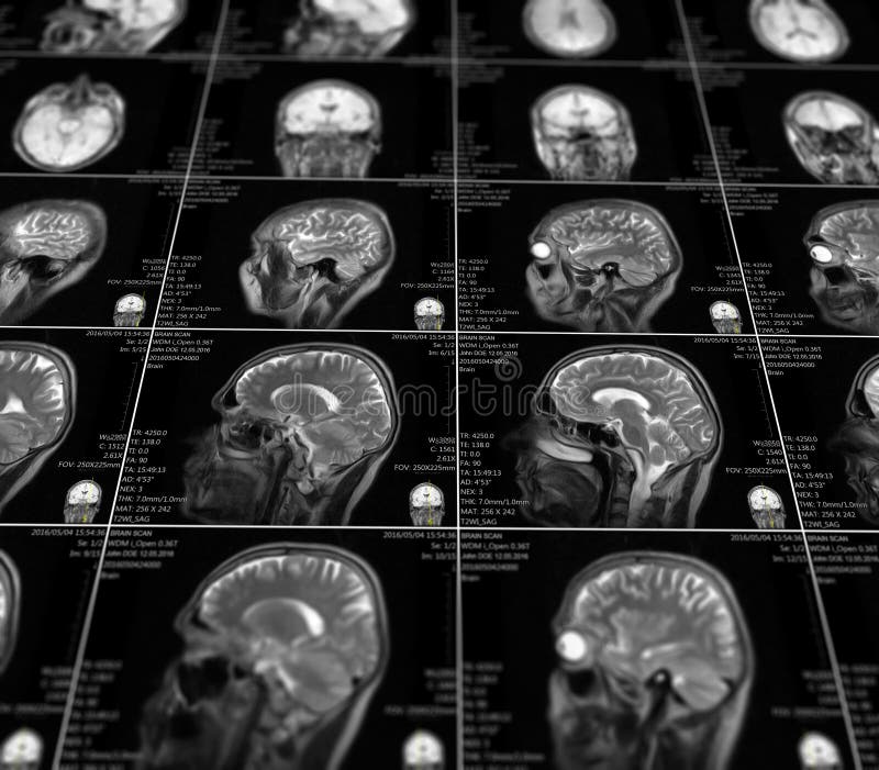 Magnetic Resonance Imaging of the Brain Stock Image - Image of scan ...