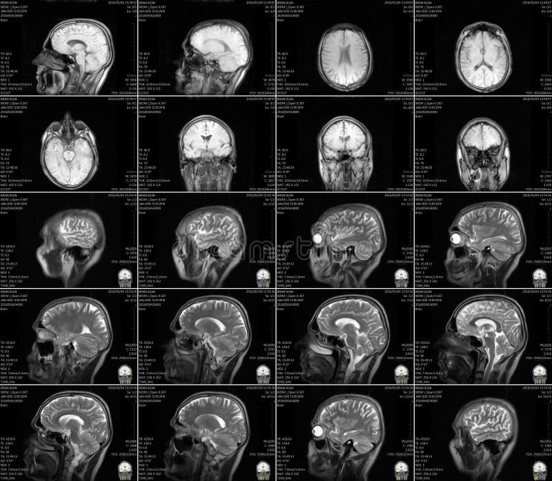 Magnetic Resonance Imaging of the Brain Stock Photo - Image of scan ...