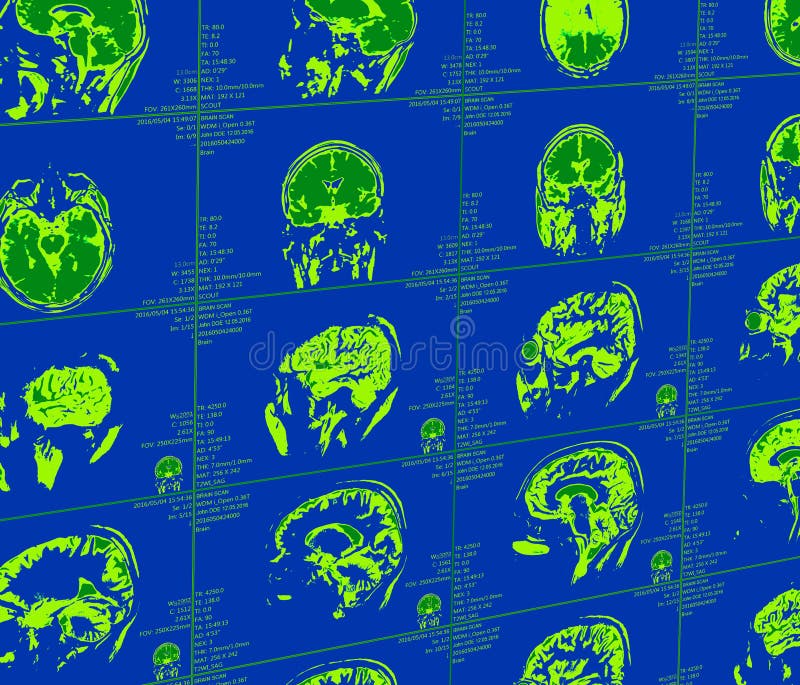 Magnetic Resonance Imaging of the Brain Stock Illustration ...