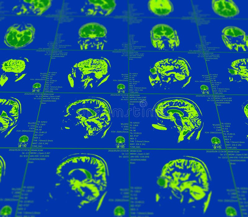 Magnetic Resonance Imaging of the Brain Stock Illustration ...