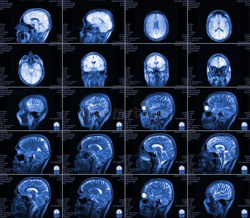 Magnetic Resonance Imaging of the Brain Stock Photo - Image of medicine ...