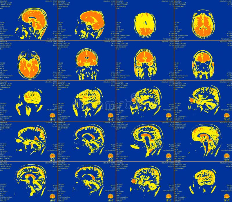 Magnetic Resonance Imaging of the Brain Stock Illustration ...