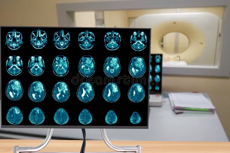 Magnetic Resonance Imaging MRI Lower Extremity Both Legs Showing Tumor ...