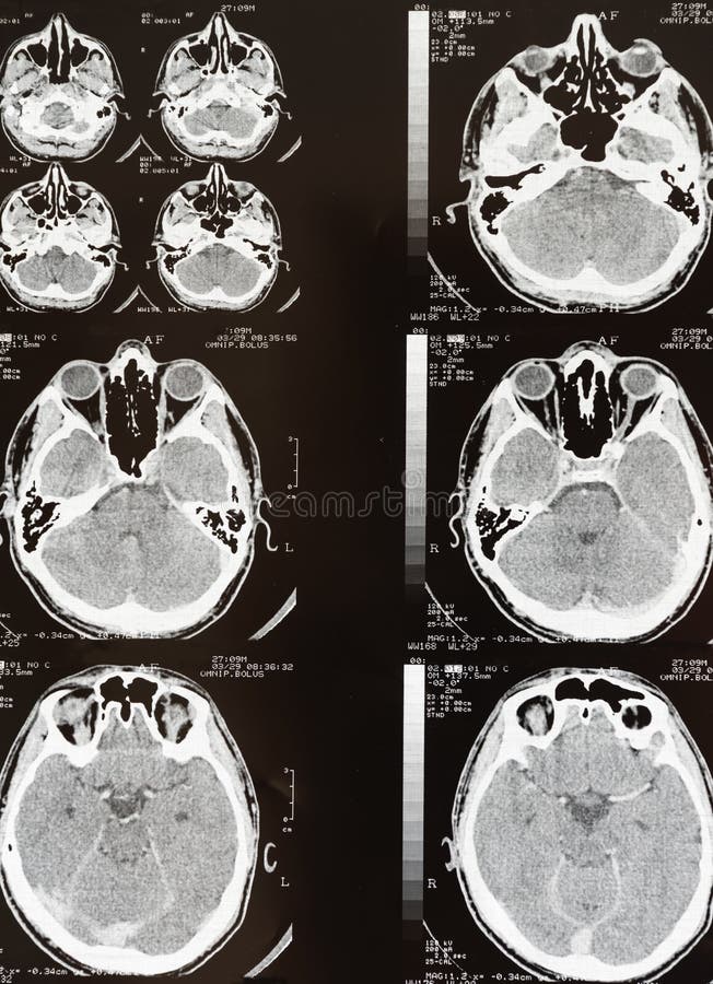 Human brain MRI scan stock photo. Image of mind, science - 227660202