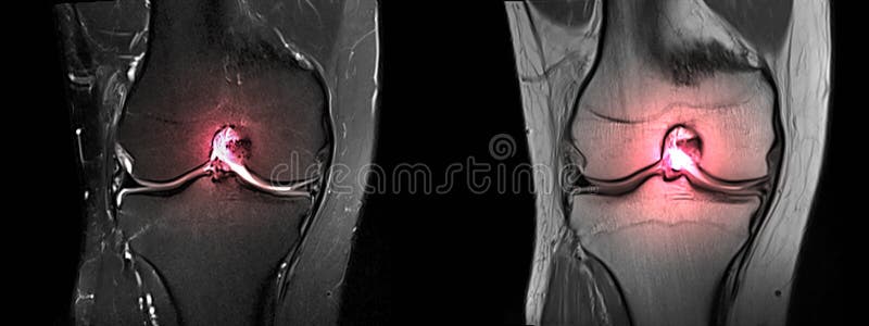 Magnetic Resonance Imaging or MRI of Knee. Stock Photo - Image of ... Magnetic Resonance Imaging or MRI of Knee. Stock Photo - Image of ...