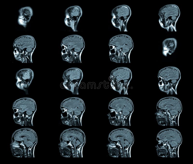 Brain Scan X-ray Mri or Magnetic Resonance Imaging of Human Head ...