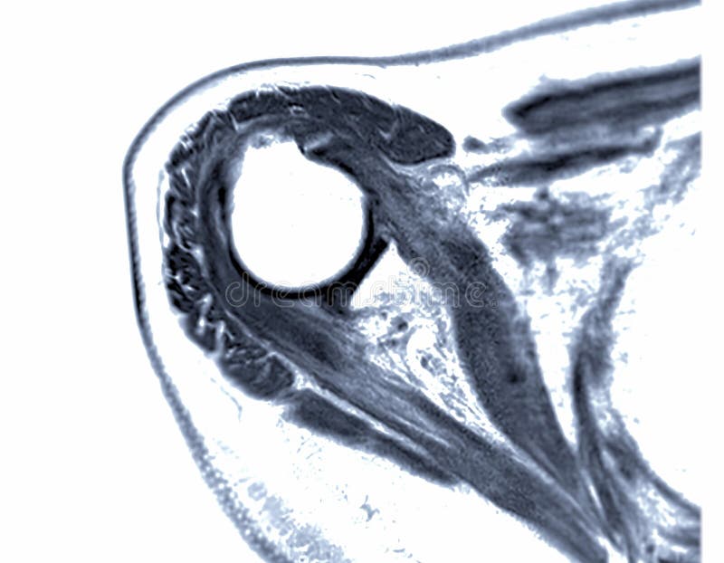 Magnetic Resonance Cholangiopancreatography or MRCP 3D MIP Image Stock ...