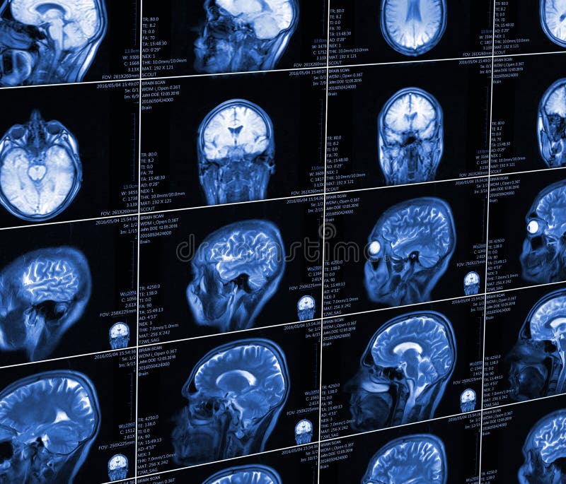 Magnetische Resonantiebeeldvorming Van De Hersenen Stock Illustratie ...