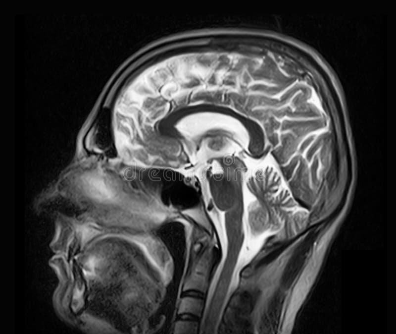 Magnetic Resonance Imaging Van De Hersenen Stock Afbeelding - Image of ...