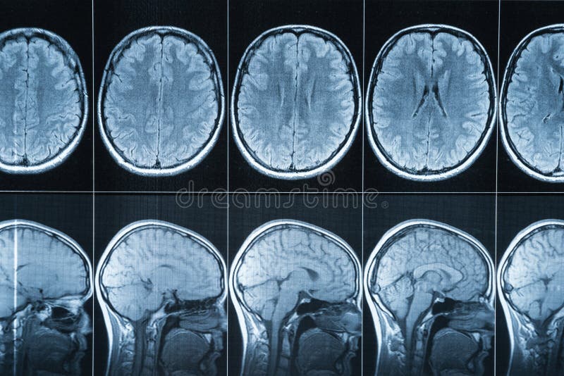 Magnetic Resonance Imaging Van Het Hoofd, MRI Stock Afbeelding - Image ...