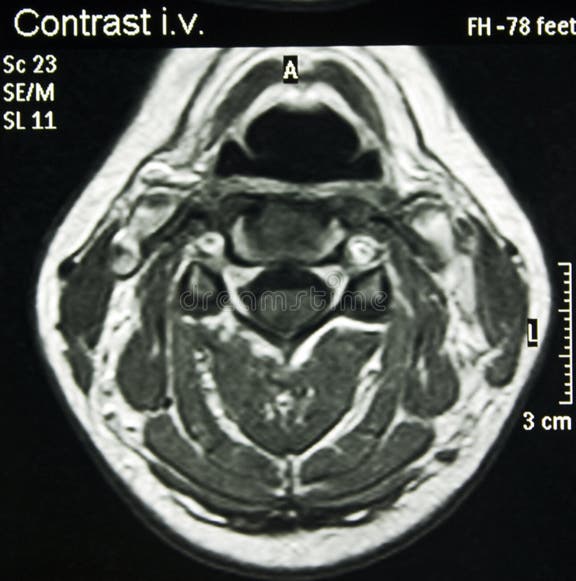 Magnetic Resonance of Neck, MR Stock Photo - Image of artery, head: 9982712