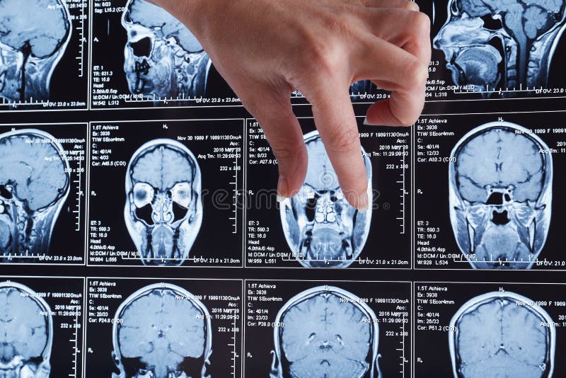 Magnetic Resonance Scan of the Brain. MRI Head Scan Stock Image - Image ...