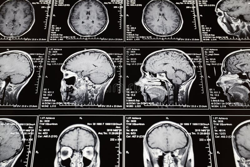 Magnetic Resonance Scan of the Brain. MRI Head Scan Stock Image - Image ...
