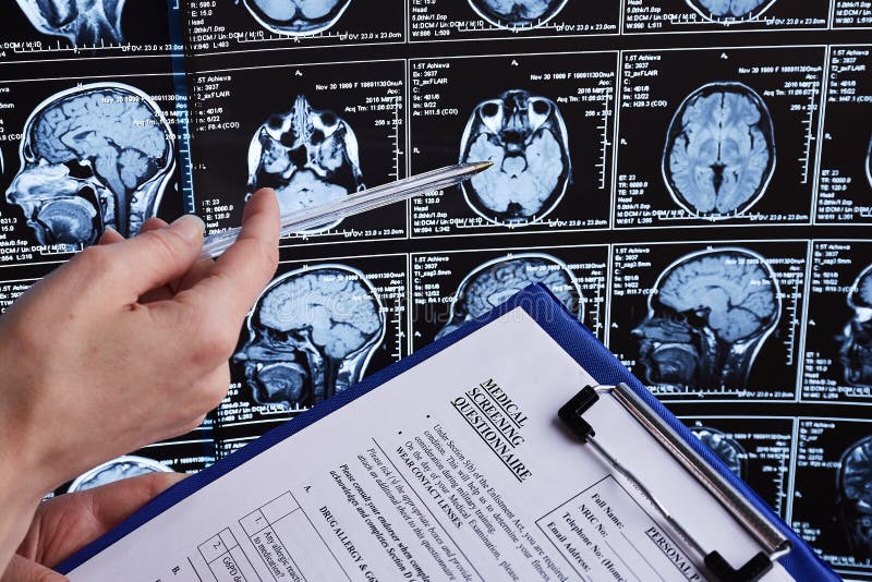 Magnetic Resonance Scan of the Brain. MRI Head Scan Stock Image - Image ...