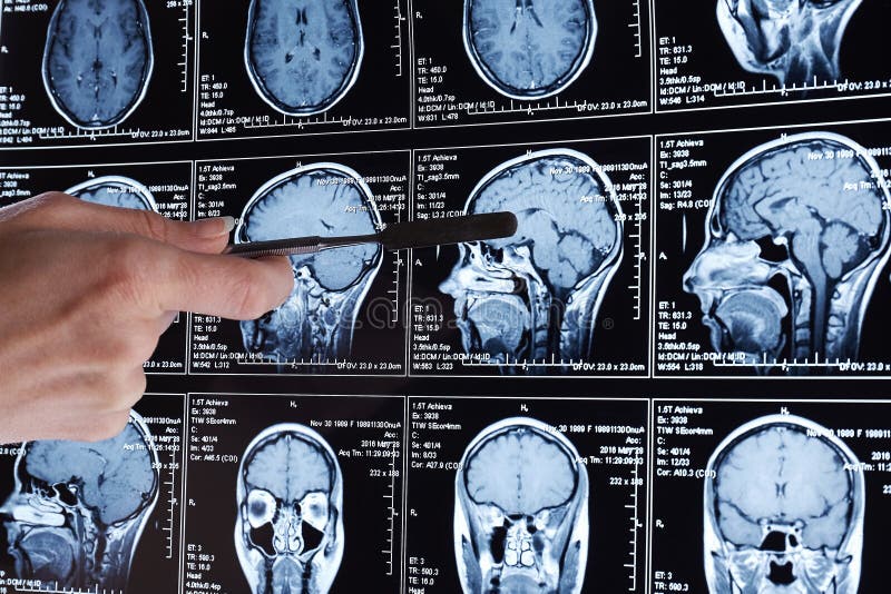 Magnetic Resonance Scan of the Brain. MRI Head Scan Stock Image - Image ...