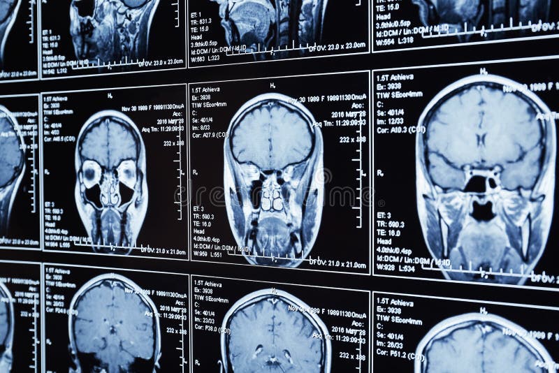 Magnetic Resonance Scan of the Brain. MRI Head Scan Stock Image - Image ...