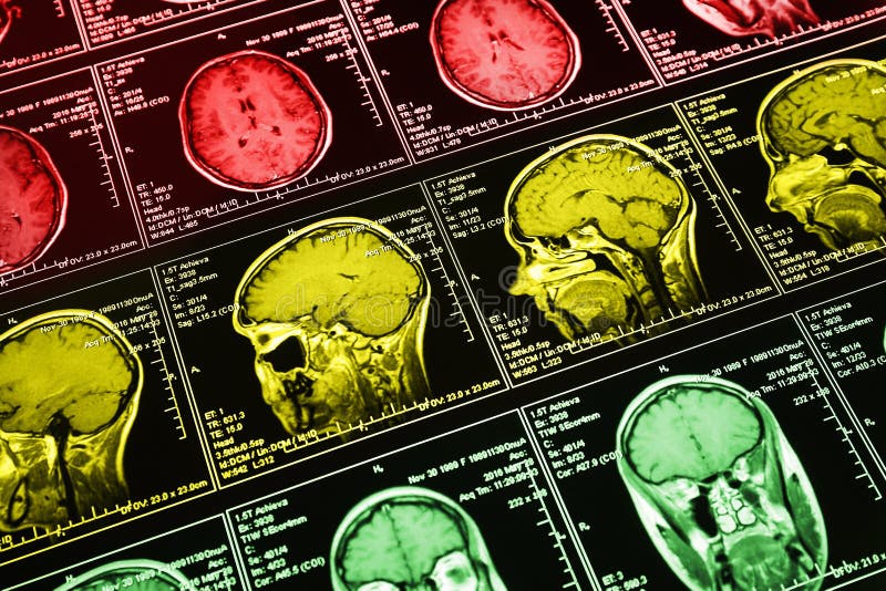 Magnetic Resonance Scan of the Brain. MRI Head Scan Stock Image - Image ...