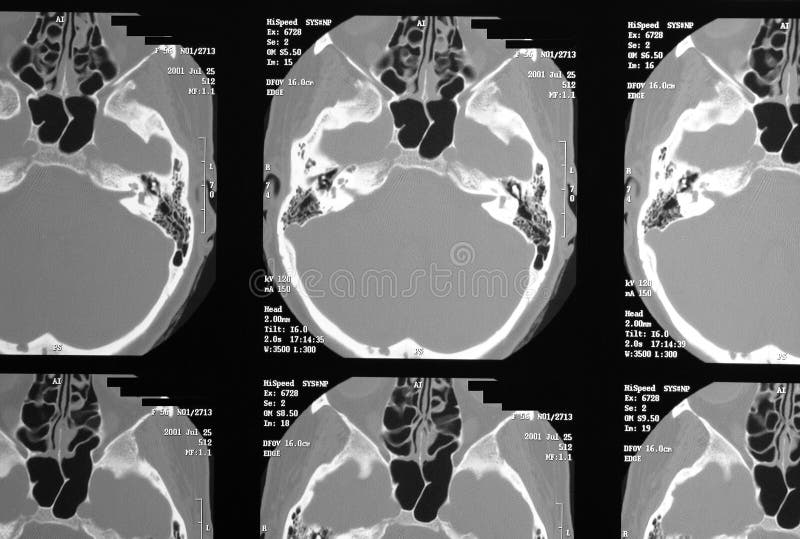 Magnetische Resonantie Van Schedel Stock Afbeelding - Image of aftasten ...