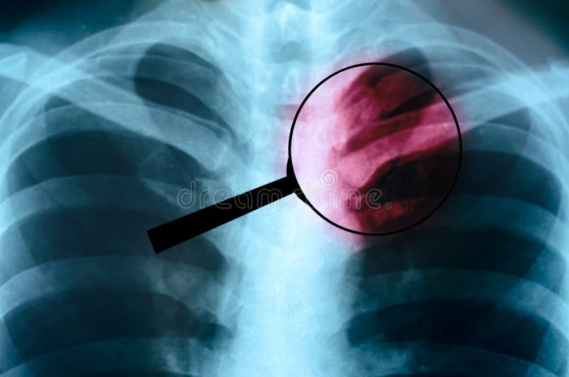 Magnified Image X-ray Human Chest is Danger Stock Illustration ...