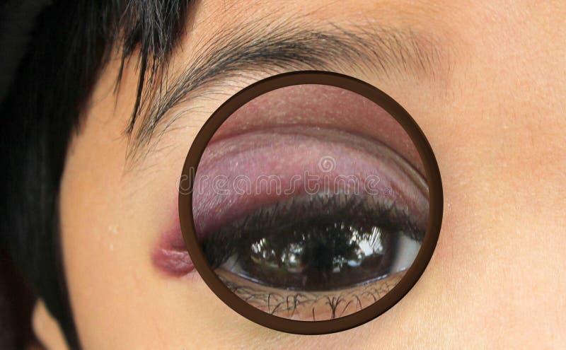 Magnifying a Black Eye stock photo. Image of injury, swelling - 93770876