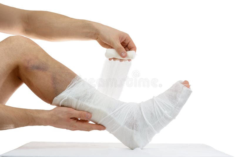 Magullado pie foto de archivo. Imagen de blanco, fractura - 168872224