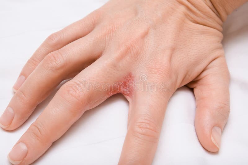 Eczéma Dyshidrotique Sur Le Pied. Dermatite Blister. Traité Avec ...