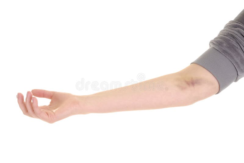 Main avec une contusion photo stock. Image du soin, passion - 4173298