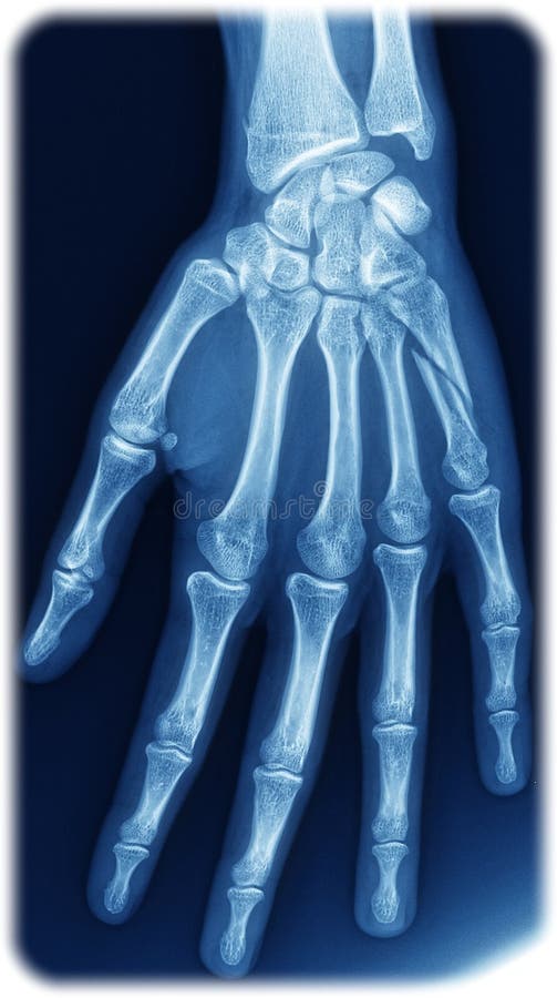 Main de rayon X illustration stock. Illustration du avec - 43185282