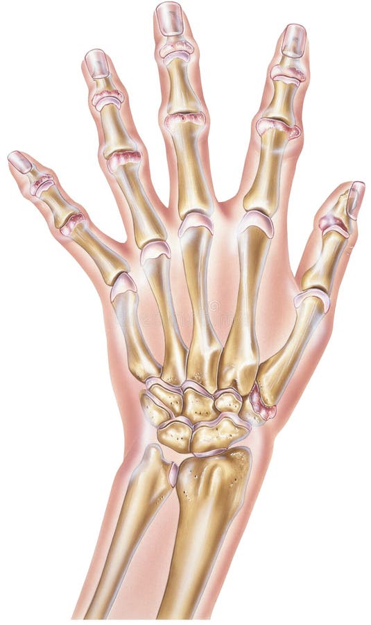 Main - Rhumatisme Articulaire Des Joints Illustration Stock ...