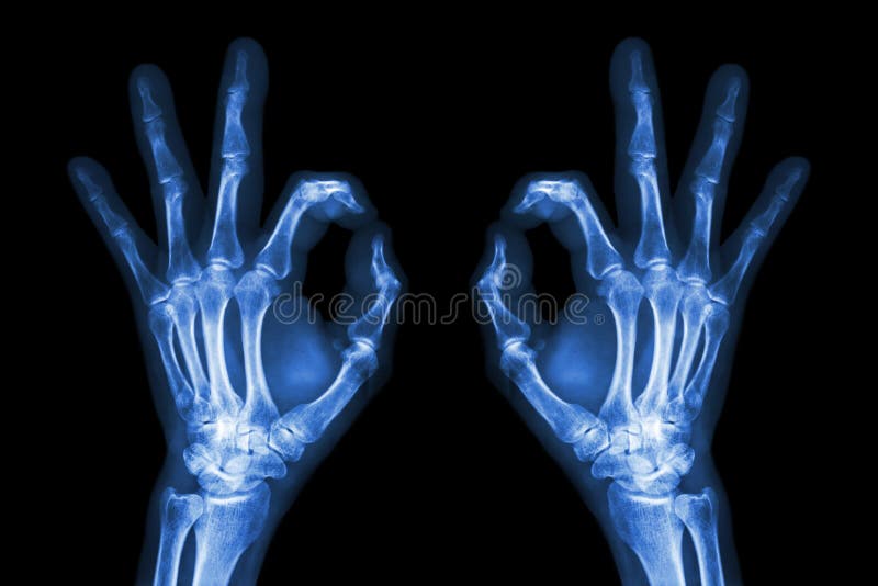 Image De Rayon X De La Main Gauche Humaine Masculine Photo stock ...
