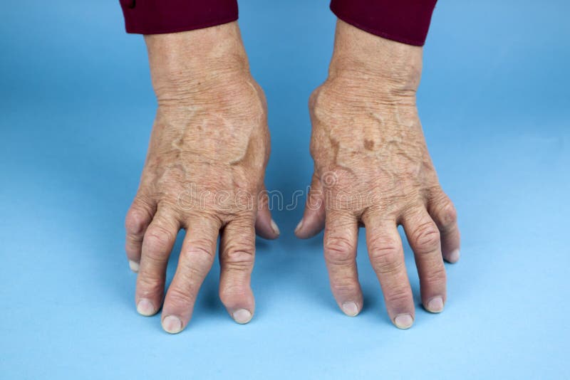 Mains Avec Le Rhumatisme Articulaire Image stock - Image du maladie ...