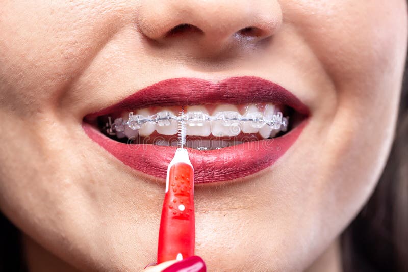 Maintaining Oral Hygiene and Keeping Braces Clean Stock Photo - Image ...