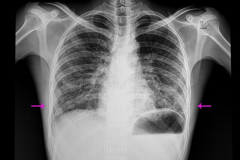 Raio X Dos Pulmões Pneumonia Do Direito Do Pulmão Negativo Foto de ...