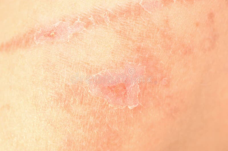 Mala piel foto de archivo. Imagen de bacterias, endémico - 21870686