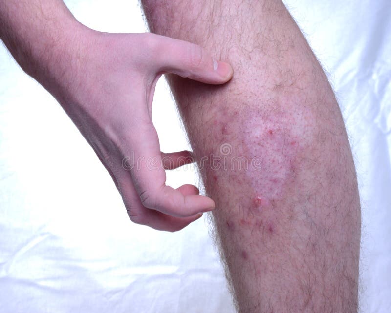 63,323 Photos de La Maladie De Peau - Photos de stock gratuites et ...