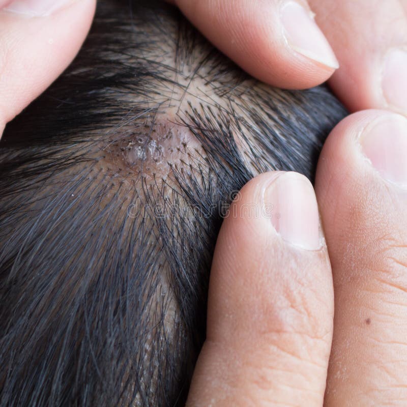 Pellicules Dans Les Cheveux Cuir Chevelu Floconneux Seborrhea Photo ...