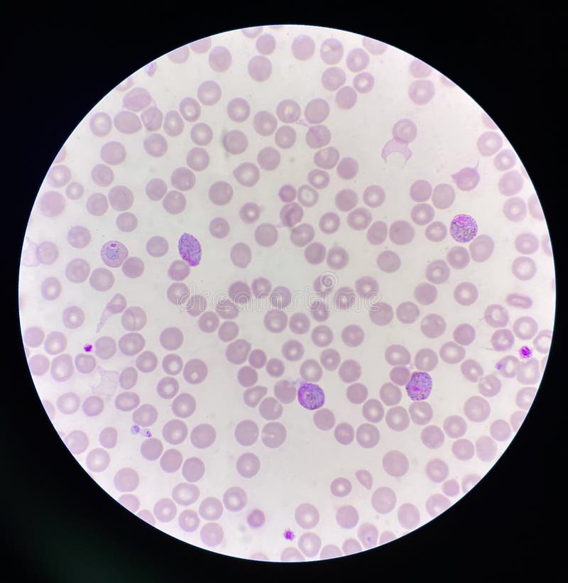 Malaria Blood Parasite Infected Red Blood Cells Stock Photo - Image of ...