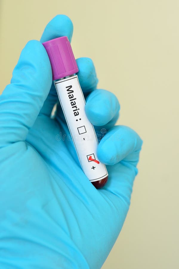 Malaria Positive Test Result Stock Image - Image of malariae, blood ...