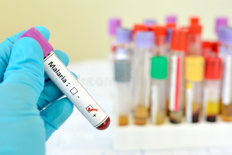 Malaria positive stock photo. Image of fever, patient - 55650174