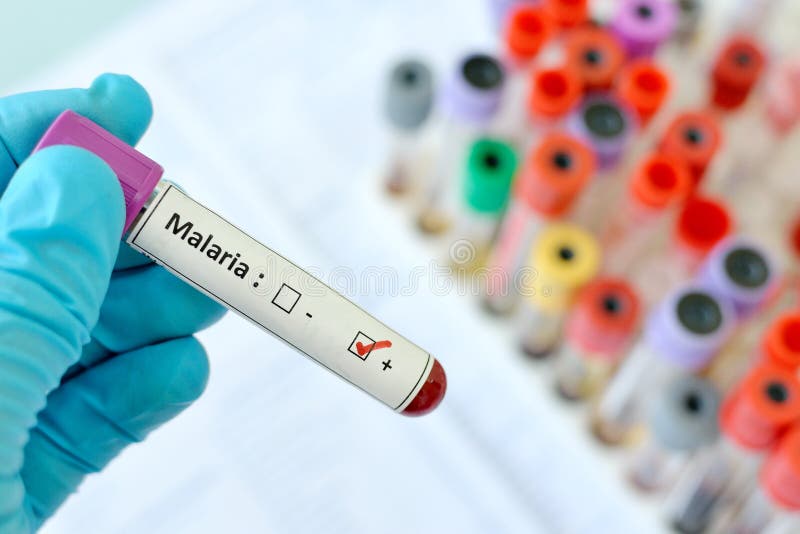 Malaria Positive Test Result Stock Image - Image of malariae, blood ...
