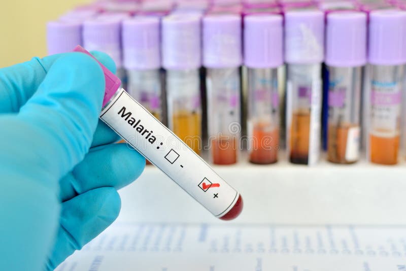Malaria Positive Test Result Stock Image - Image of malariae, blood ...
