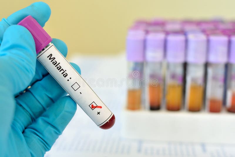 Malaria Positive Test Result Stock Image - Image of malariae, blood ...
