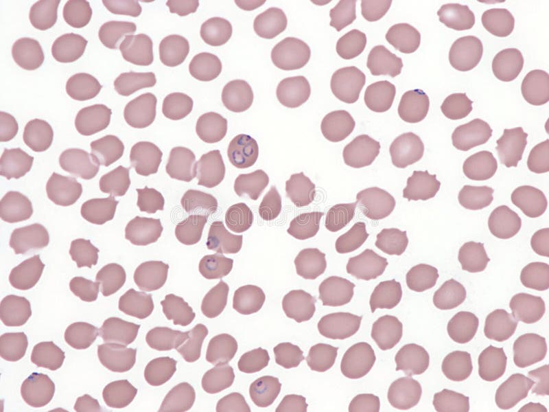 Malaria.Ring Forms of Plasmodium Falciparum in Peripheral Blood. Stock ...