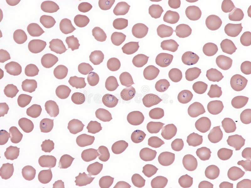 Malaria.Ring Forms of Plasmodium Falciparum in Peripheral Blood. Stock ...