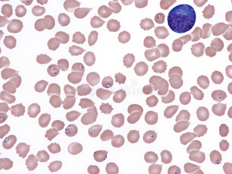 Malaria.Ring Forms of Plasmodium Falciparum in Peripheral Blood. Stock ...